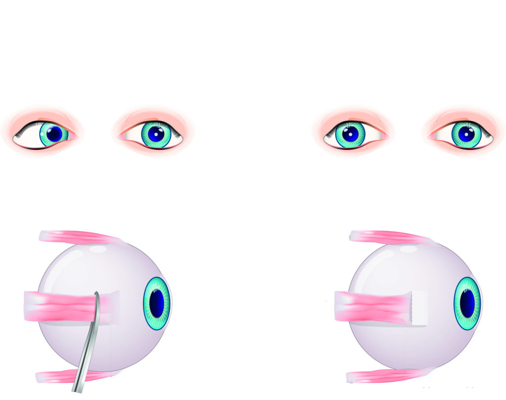 Meine OP: Schiel-Operation Erwachsene - klinikguide.at - Gesundheit finden