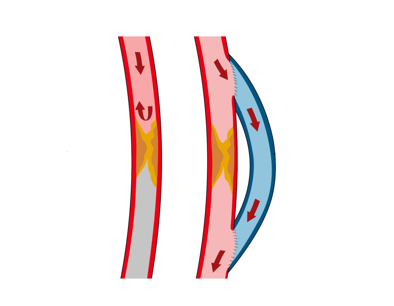 Meine OP: Bypass-Operation - klinikguide.at - Gesundheit finden