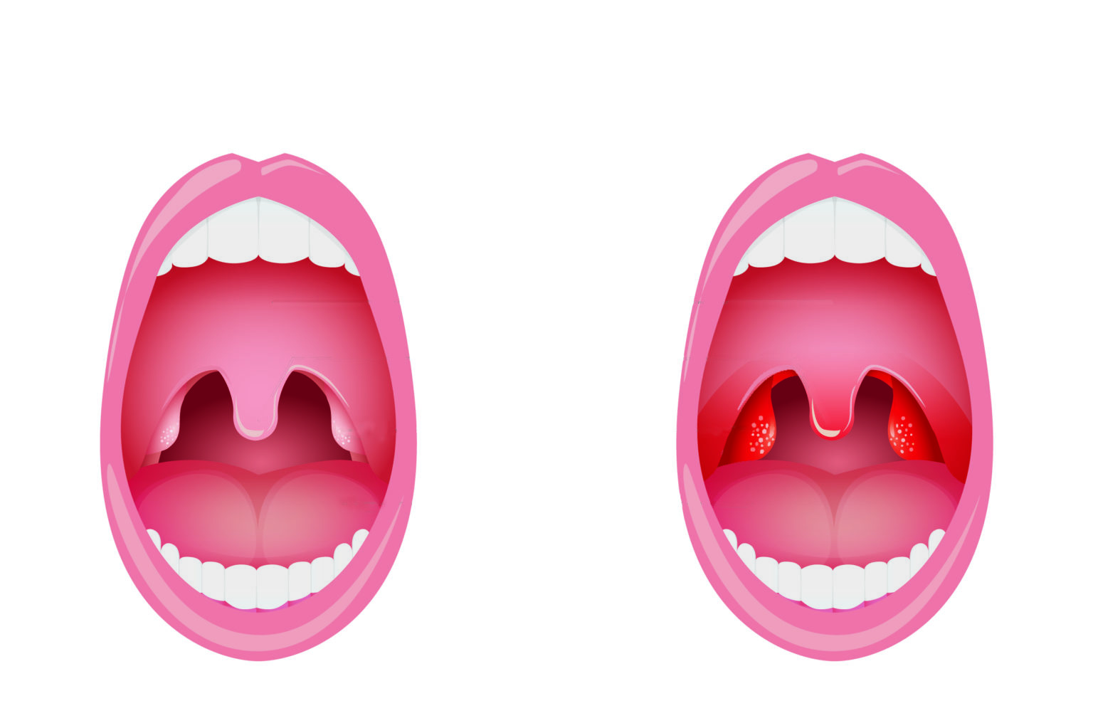 Meine OP: Mandel-Operationen - klinikguide.at - Gesundheit finden